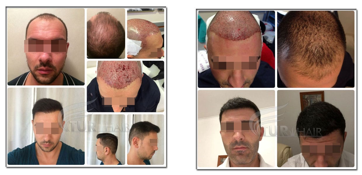 FUE Method - Hair Transplantation in Turkey | TURHAIR | DR DEMIR